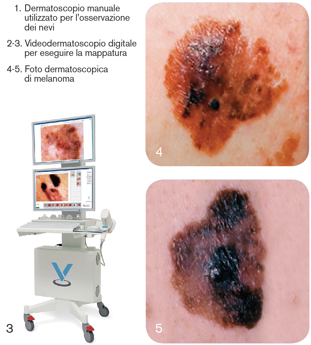 Prevenzione melanoma, Screening dermatologico, Videodermatoscopio