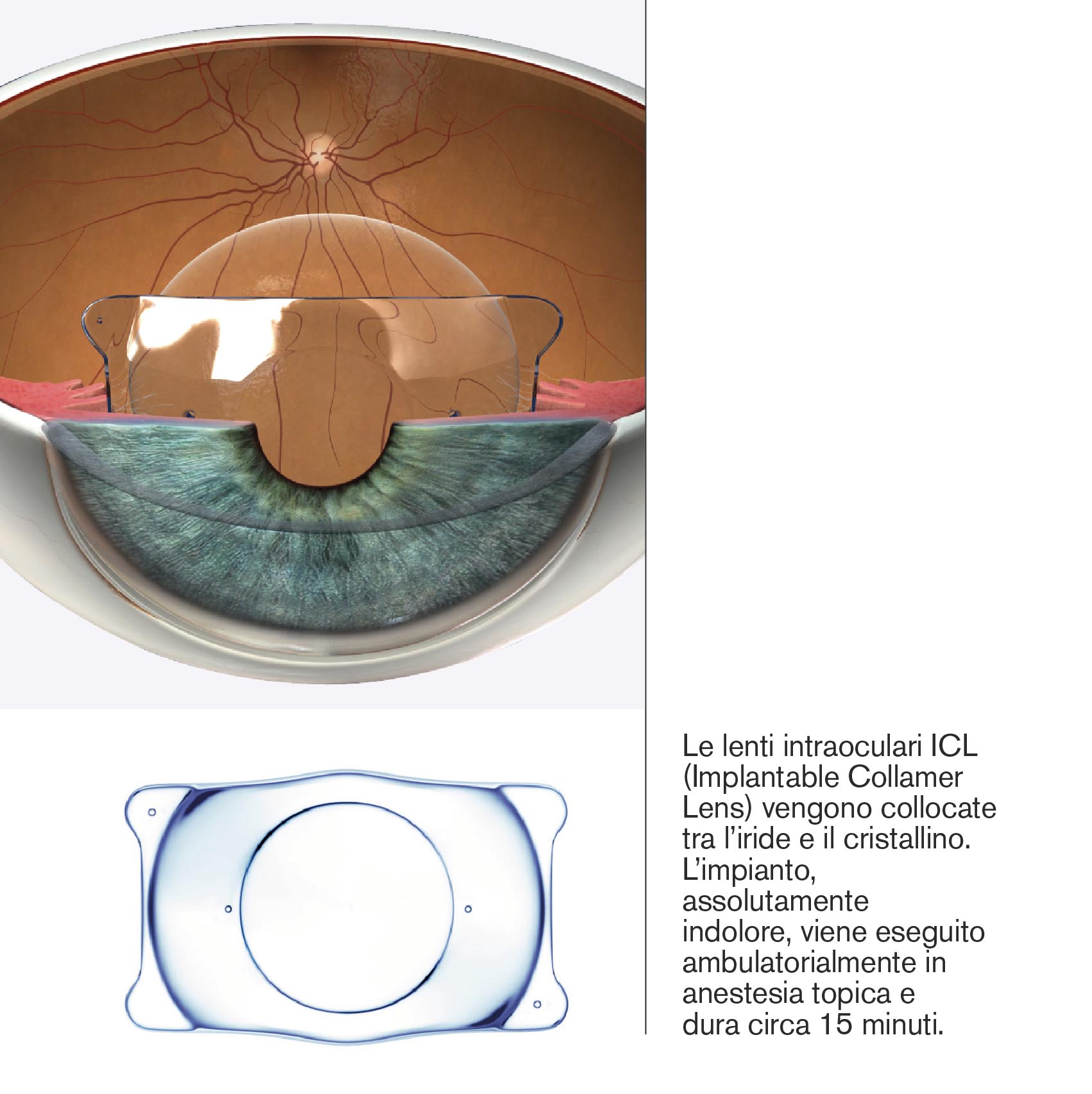 Difetti visivi elevati, Lenti intraoculari ICL, Lenti IOL